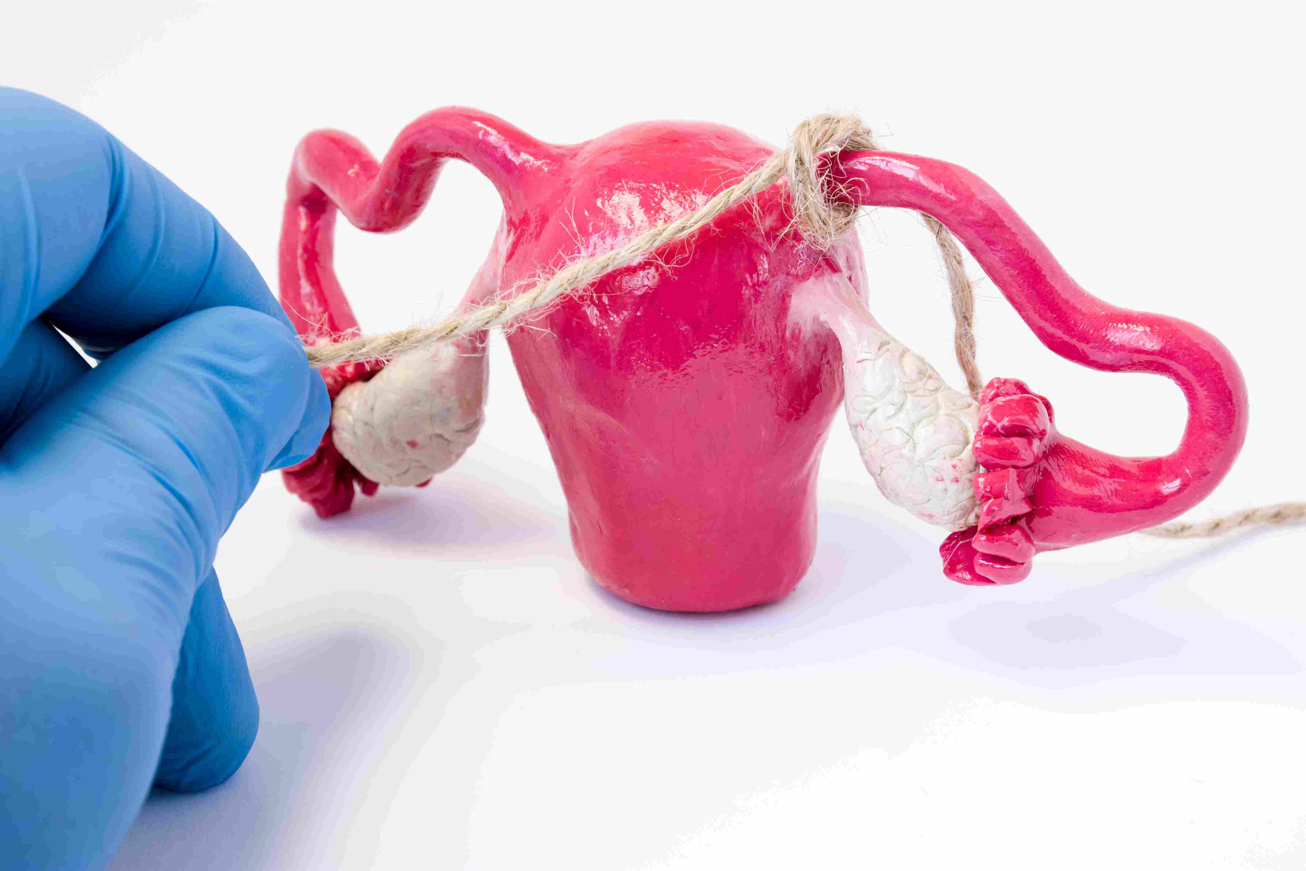 Salpingoclasia. Ligadura de trompas. OTB. Unidades Médicas